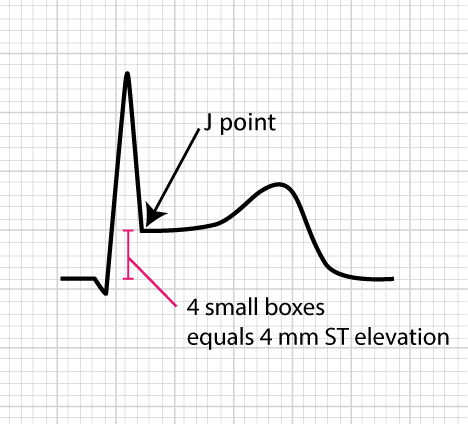 Interpreting ST Elevations On An ECG (electrocardiogram)- 2024