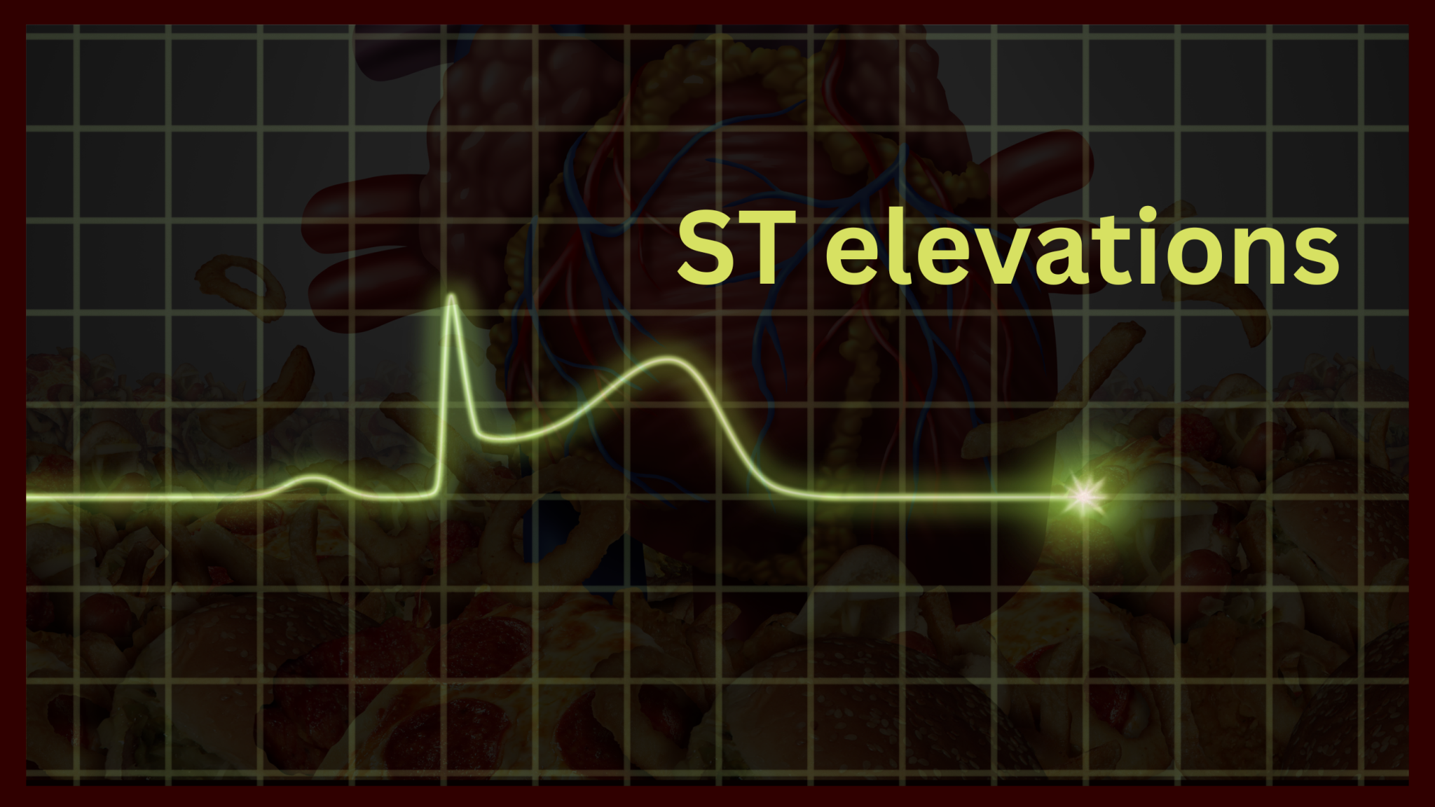 Interpreting ST Elevations On An ECG (electrocardiogram)- 2024