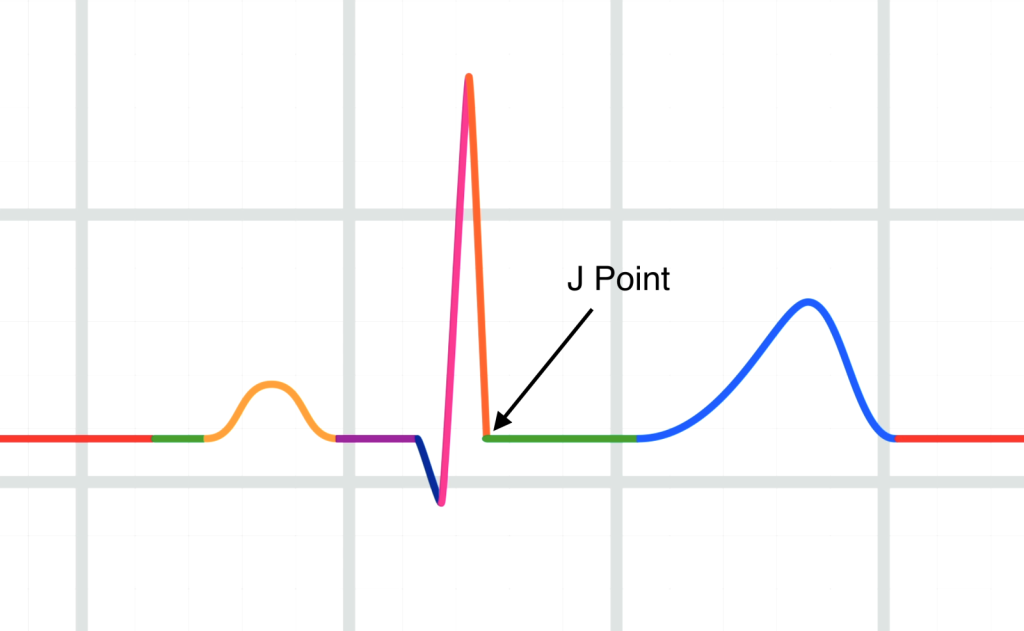 Interpreting ST Elevations On An ECG (electrocardiogram)- 2024